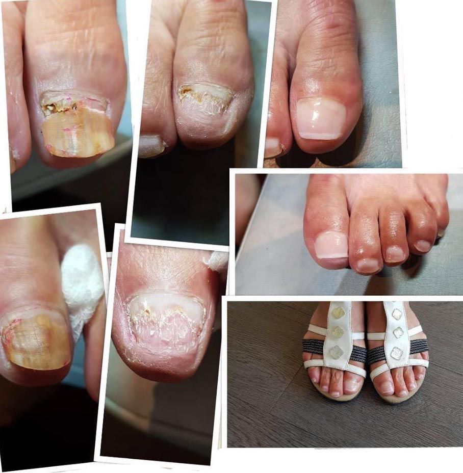 Nail Reconstruction - The Foot Health Company