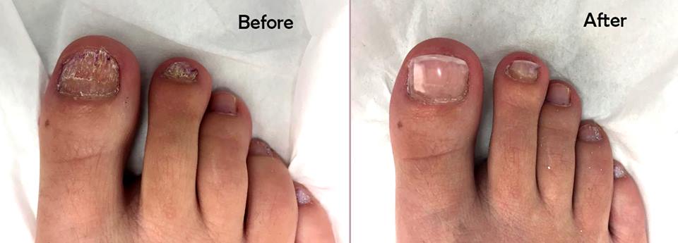 Nail Reconstruction - The Foot Health Company